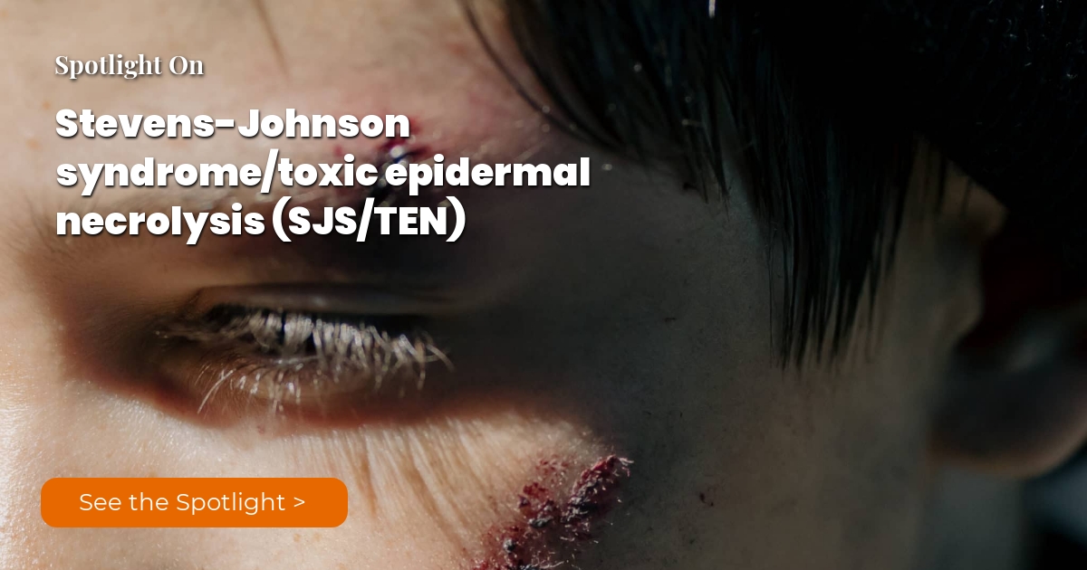 Stevens-Johnson syndrome/toxic epidermal necrolysis (SJS/TEN) - Rare Immunology News
